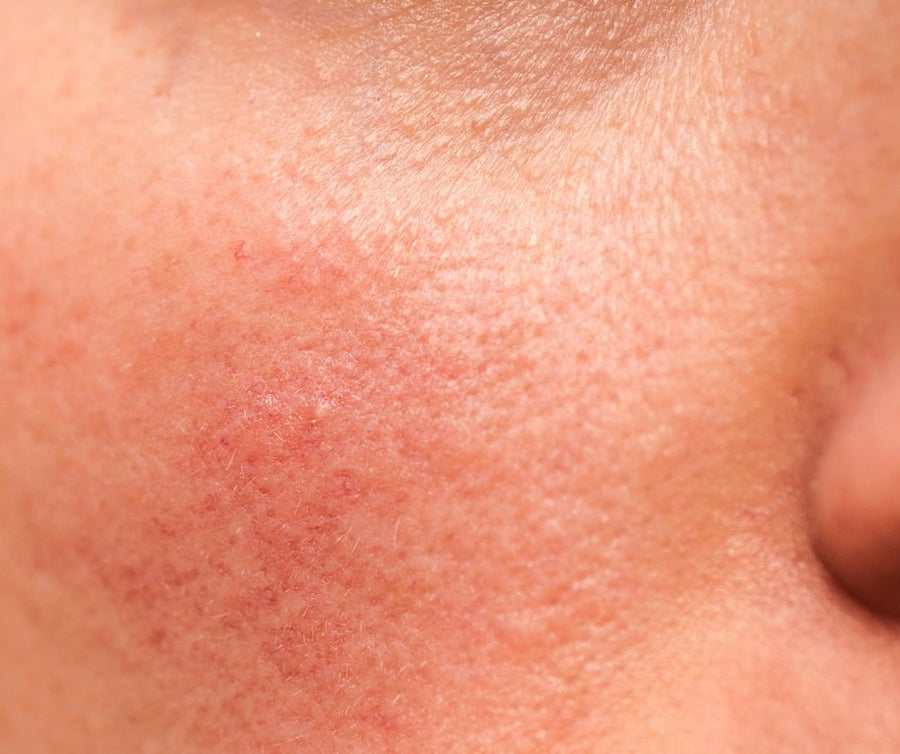 Couperose Skin Vs. Rosacea: What's the Difference? – Mukti Organics